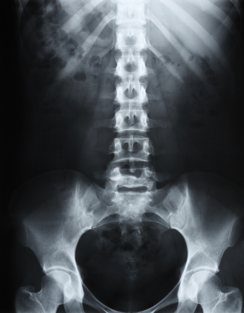Low Back Pain: Should I Get X-ray Imaging? Back Pain